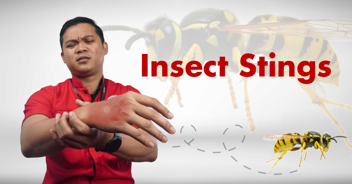 Basic Life Support for Insect Stings: Managing and Treating in Malaysia ...
